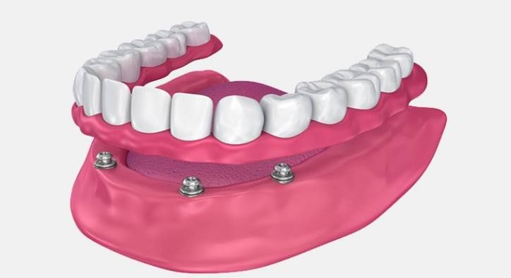 Dental Implant Types and Prices